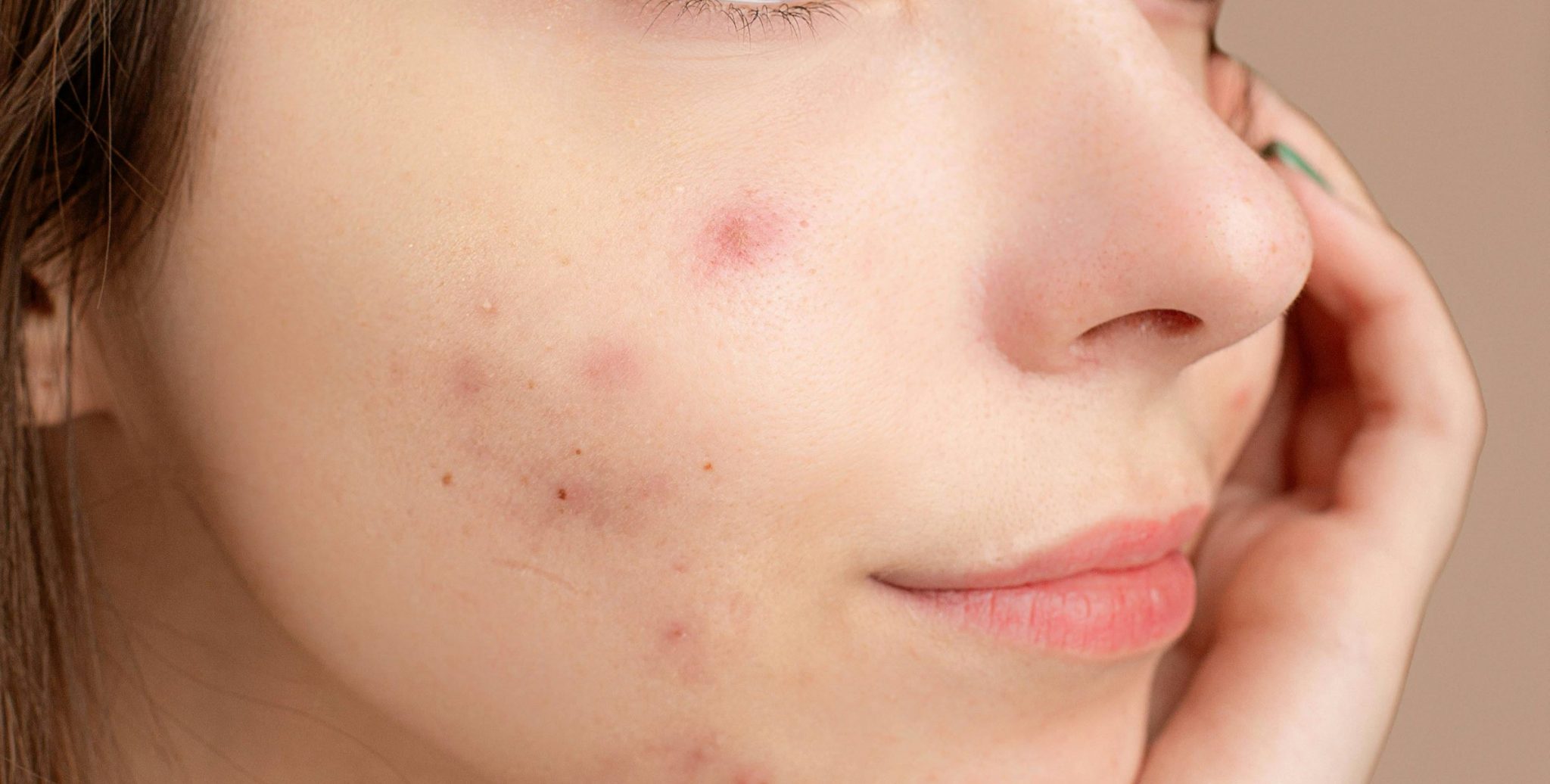 What STIs can cause a face rash?